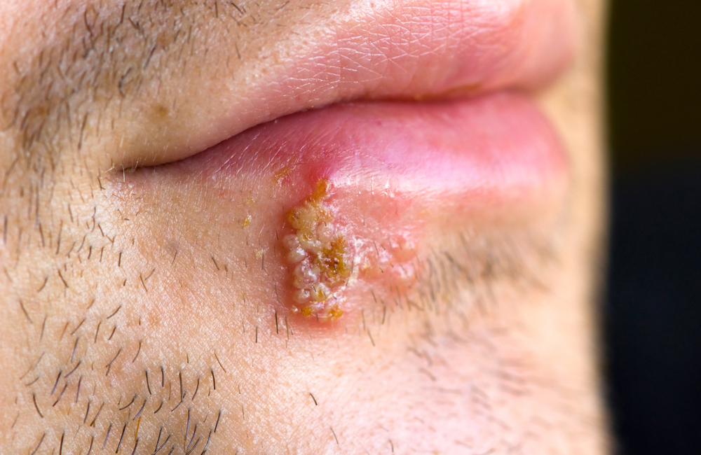 Mouth Problems And Hiv Aidsmap